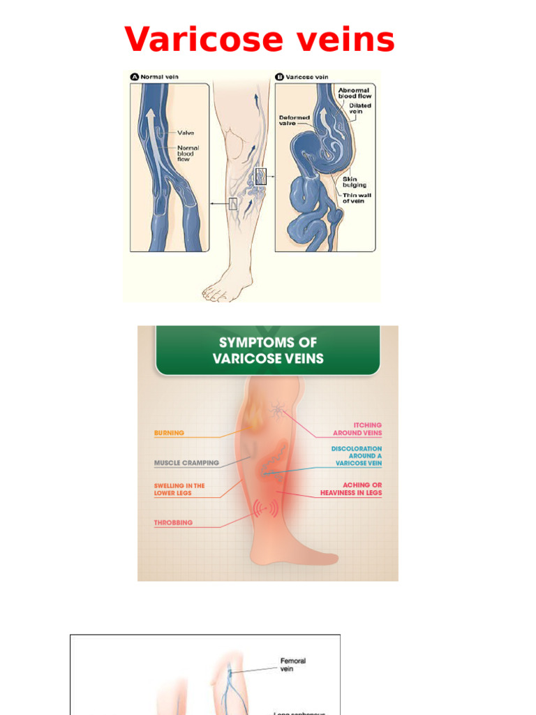 Varicose Veins Examination | PDF