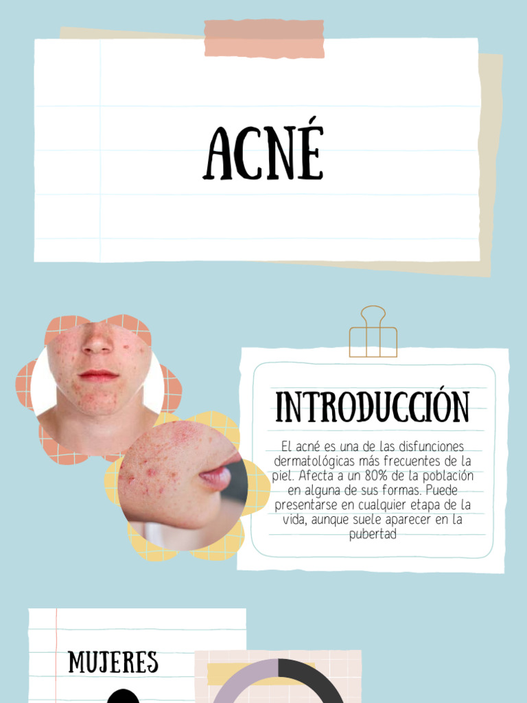 ACNE | PDF
