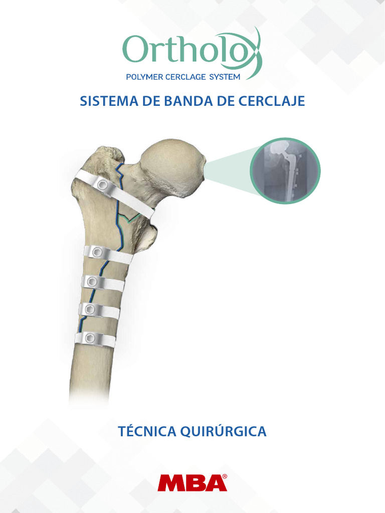 Ortolog I.309es Ortholox Sistema de Banda de Cerclaje TQ V4 WEB | PDF