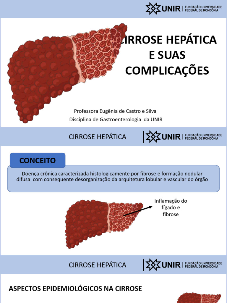Cirrose Hepatica e Suas Complicações 2022 | PDF