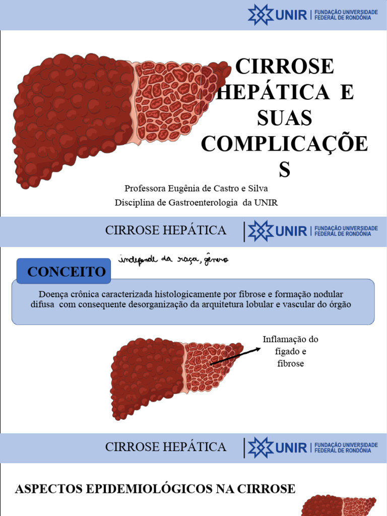 Aula 03 08 Ago Cirrose Hepatica | PDF