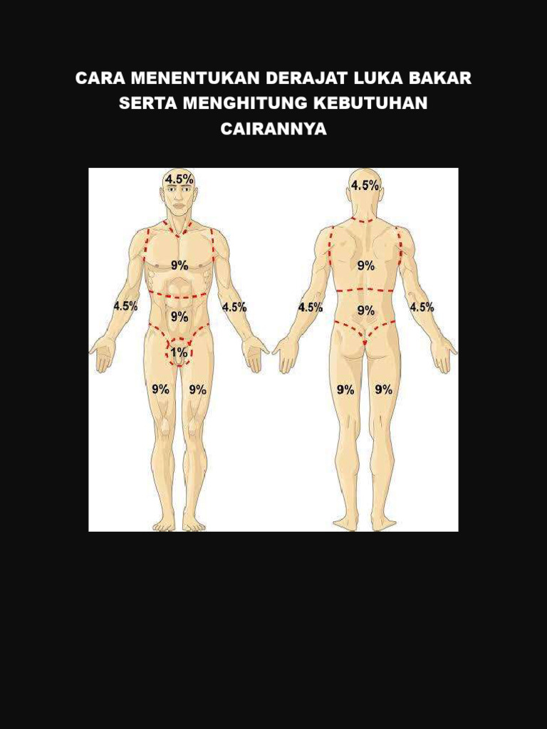 CARA MENENTUKAN PRESENTASE LUKA BAKAR SERTA MENGHITUNG KEBUTUHAN CAIRANNYA | PDF