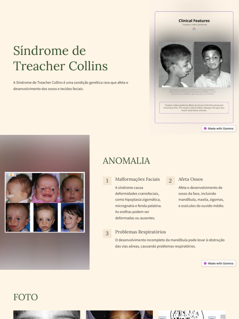 Sindrome de Treacher Collins | PDF