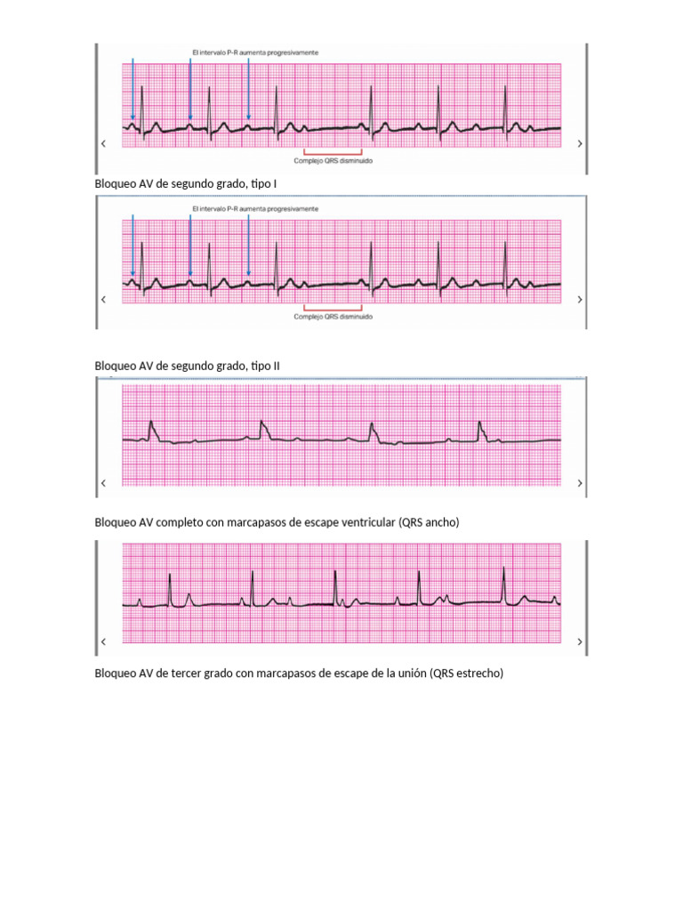 Ekg Acls | PDF | Seni