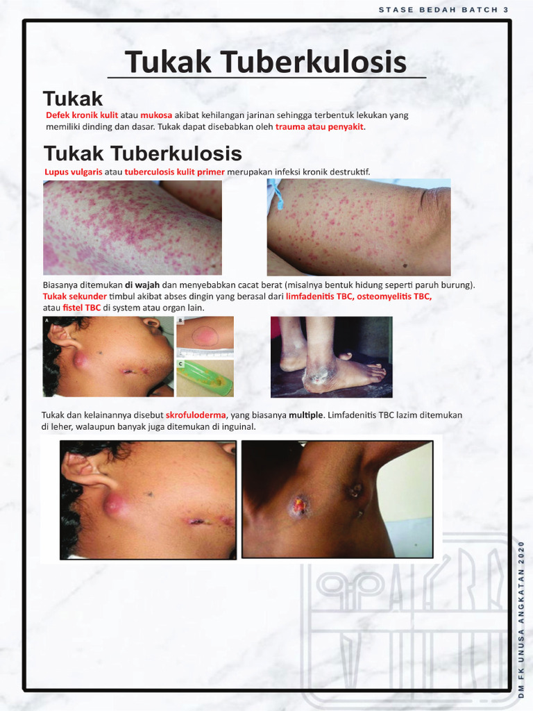 Tukak Tuberkulosis | PDF