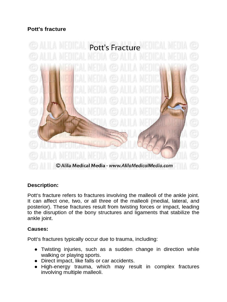 Pott's Fracture | PDF