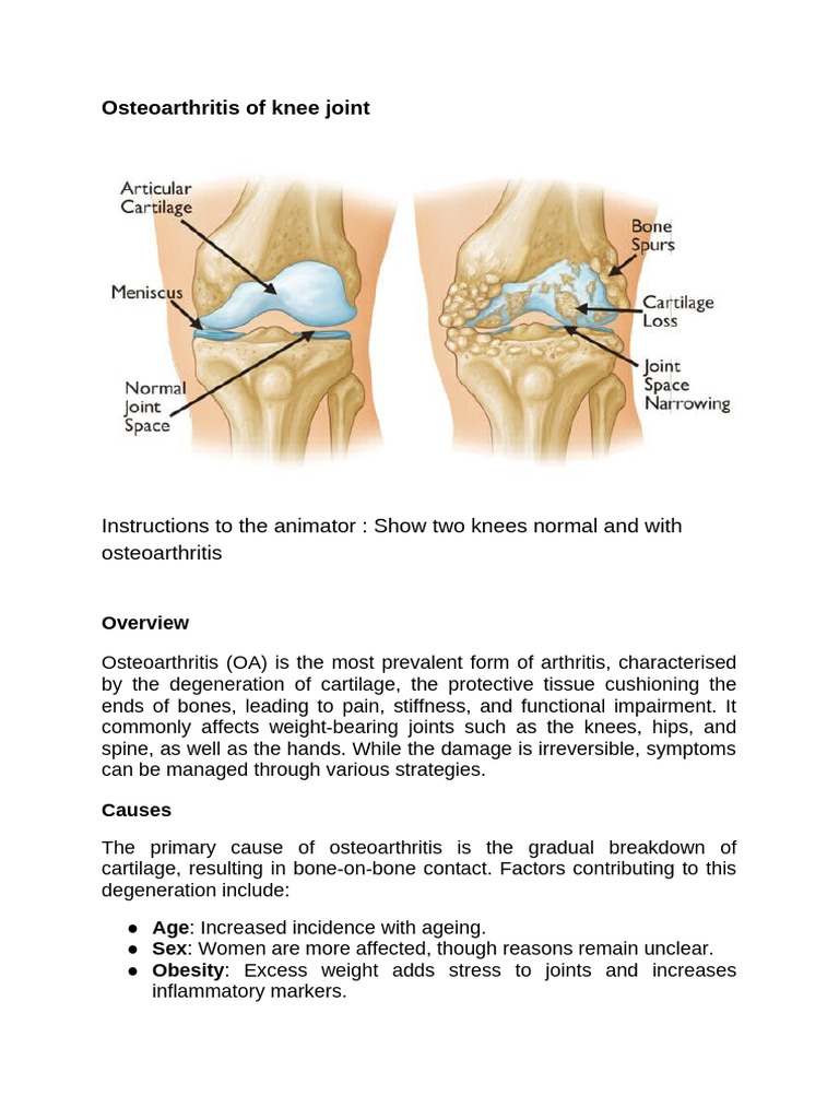 Osteoarthritis of Knee Joint | PDF
