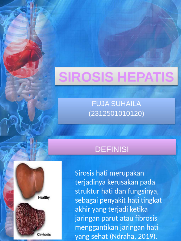 Dokumen - Tips PPT Sirosis Hepatis 5652d804ede60 | PDF