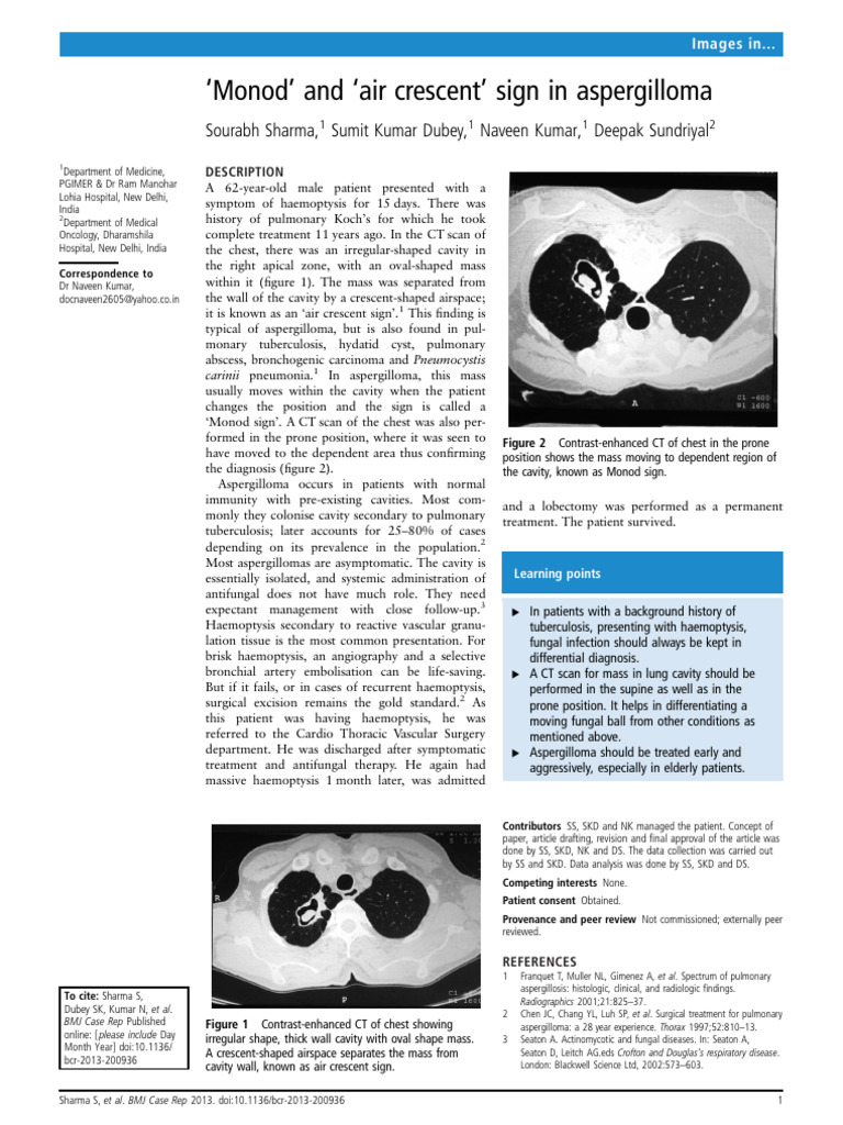 Red Flag - Articulo Monod and Air Crescent Sign in Aspergilloma | PDF