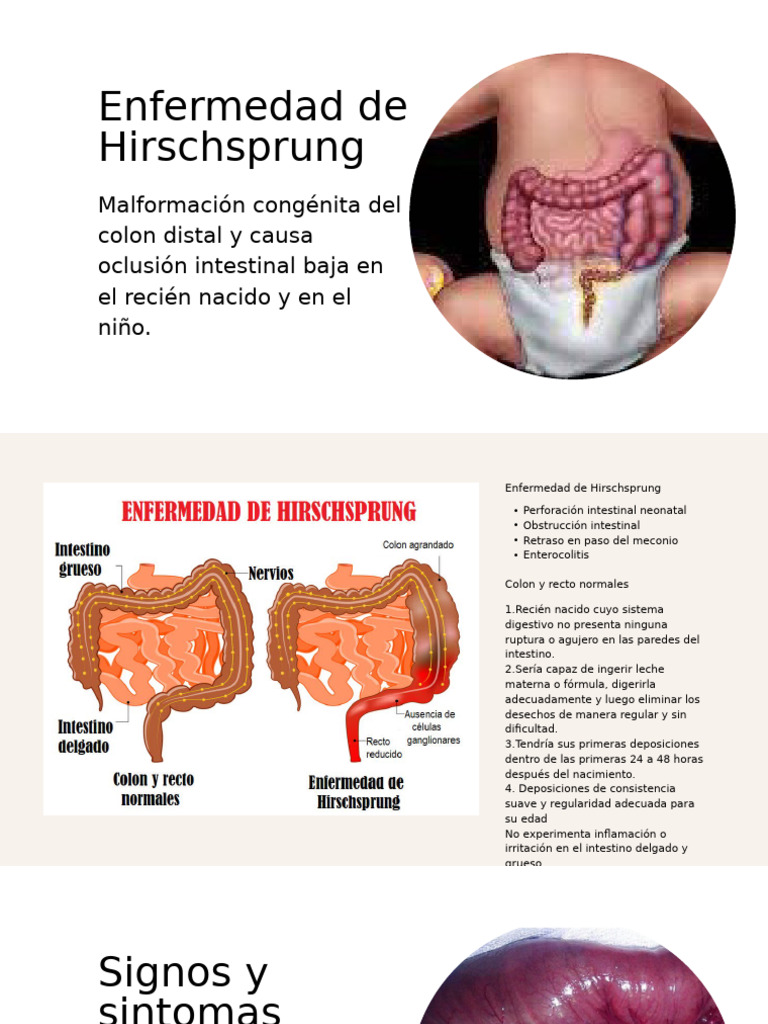 Enfermedad de Hirschsprung | PDF