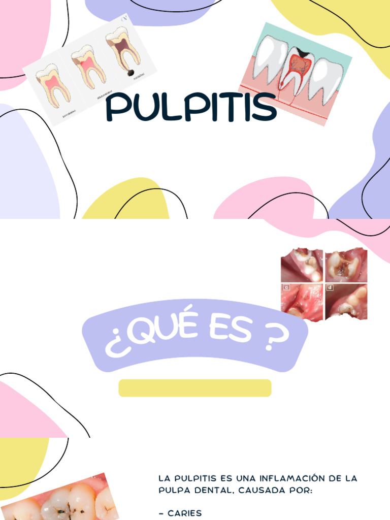 Pulpitis | PDF