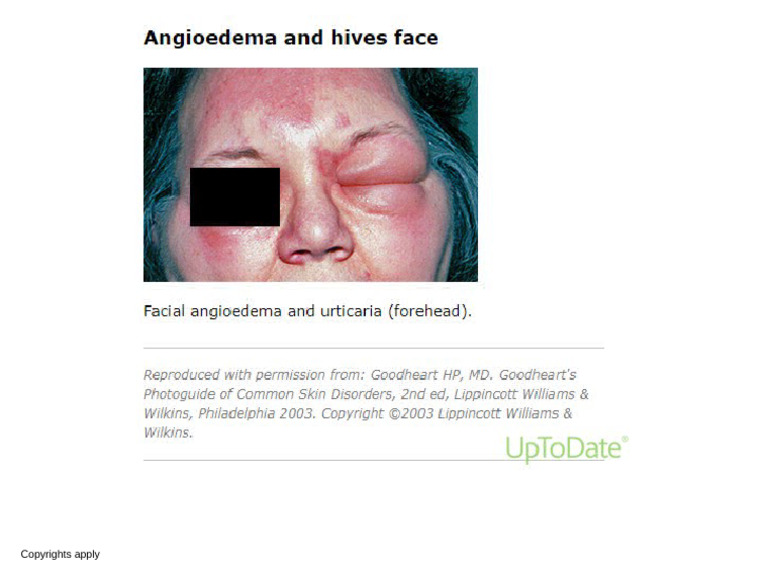 Angioedema and Hives Face | PDF