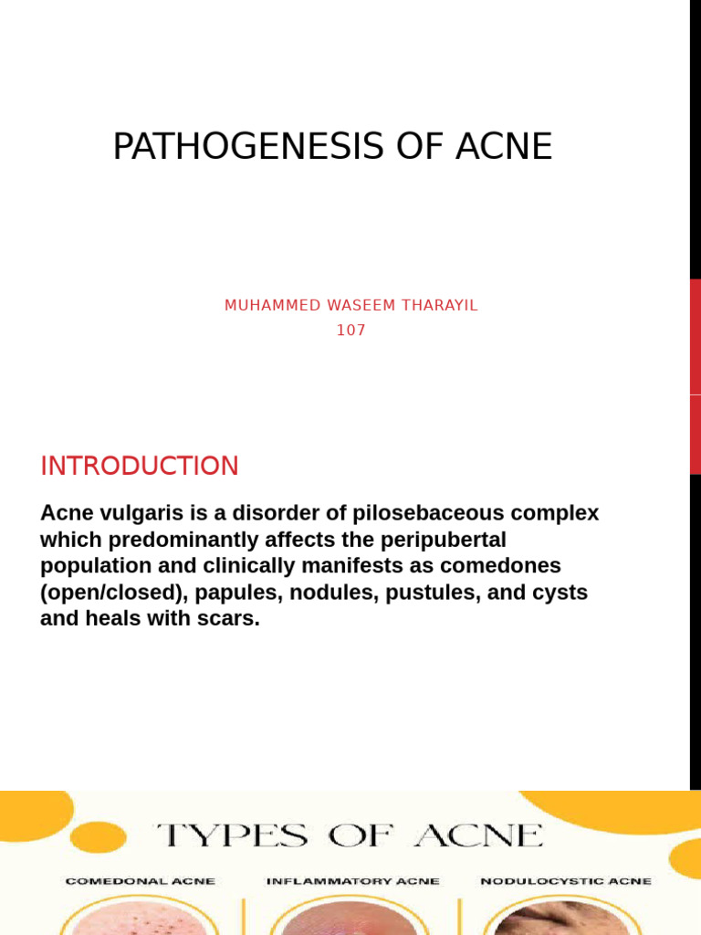 Acne Pathogenesis Muhammed Waseem | PDF