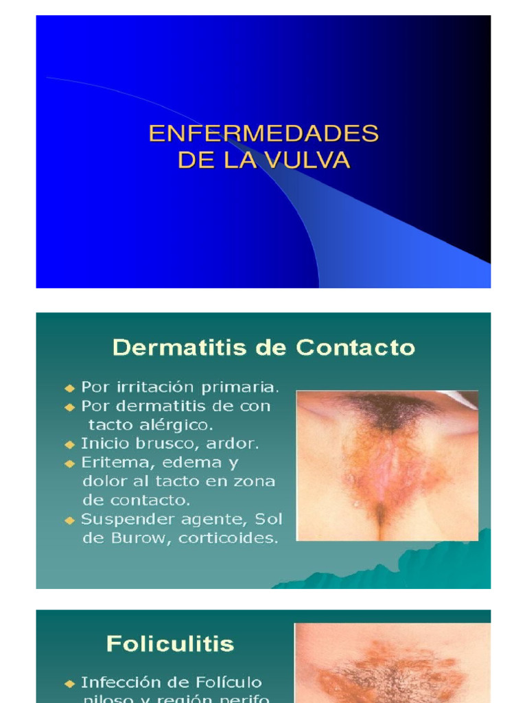 Enfermedades de La Vulva | PDF