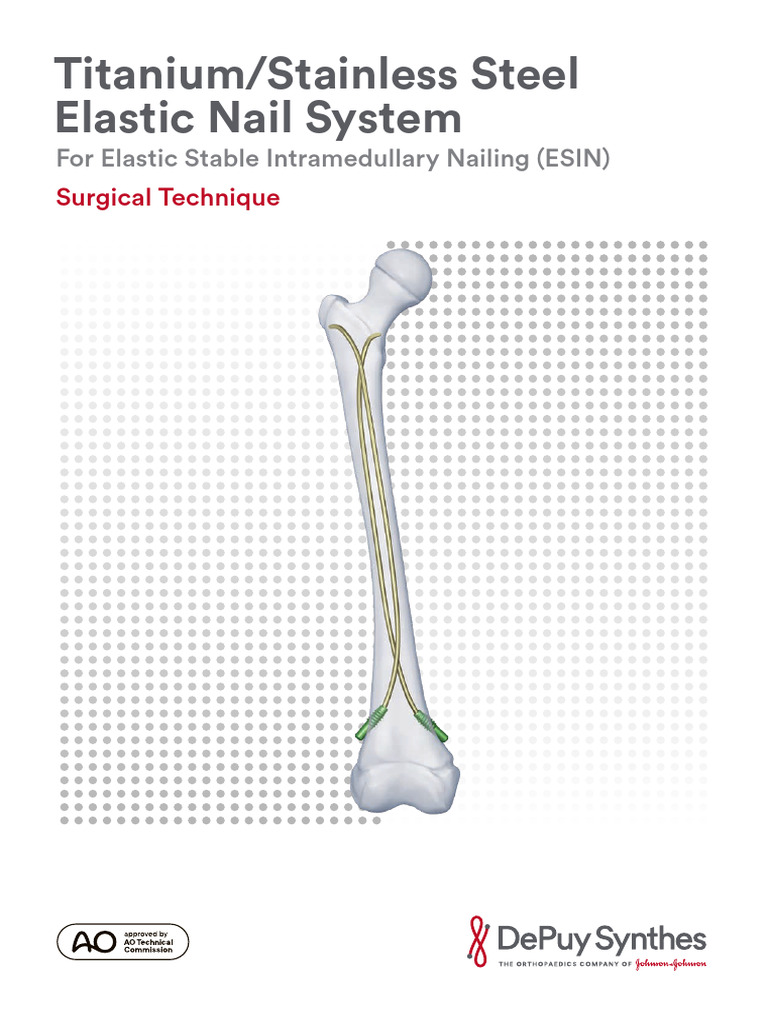 Titanium/Stainless Steel Elastic Nail System: For Elastic Stable Intramedullary Nailing (ESIN) | PDF