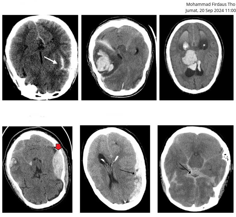 Hasil X-Ray (Mohammad Firdaus Thol) | PDF