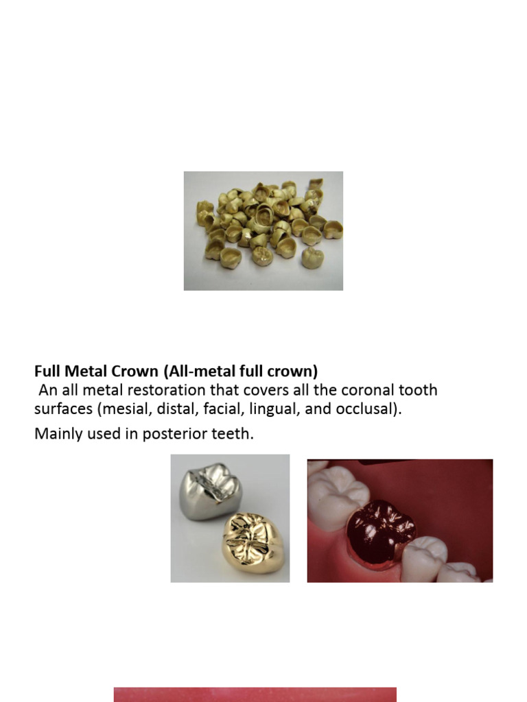 Full Metal Full Veneer Crown Preparation | PDF