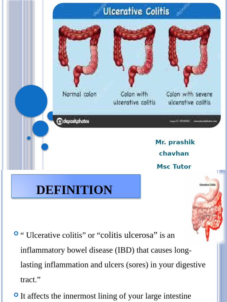 Ulcerative Colitis | PDF