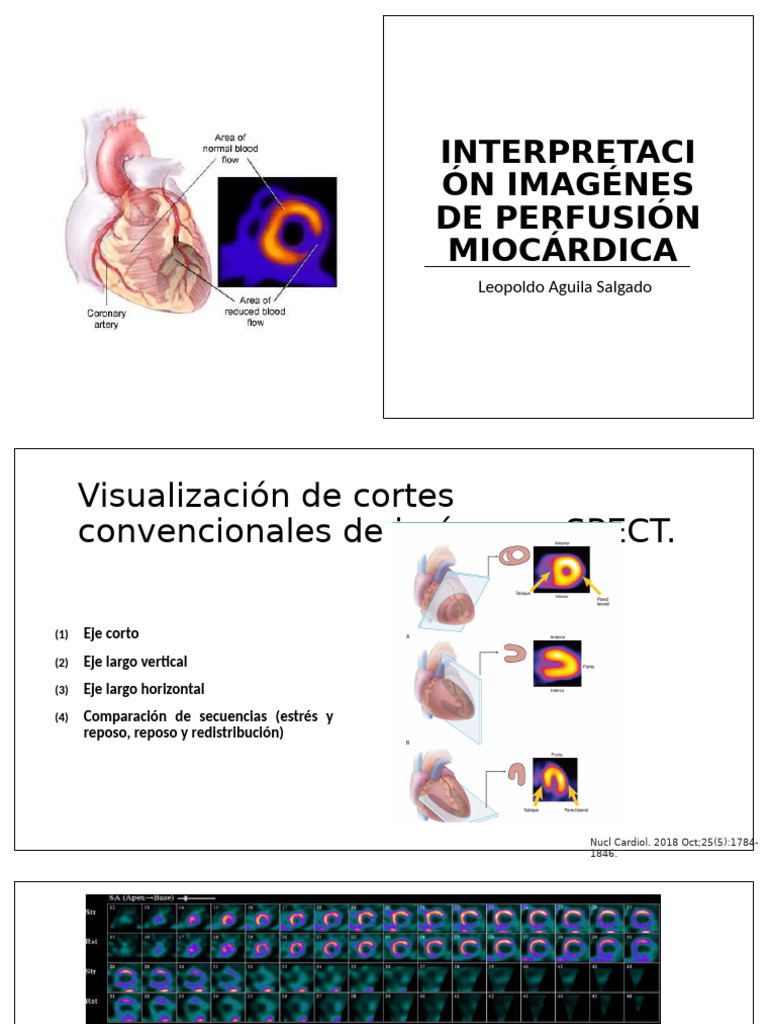 Interpretación SPECT | PDF