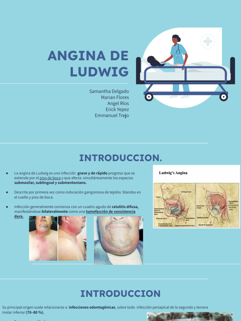 Angina de Ludwig | PDF