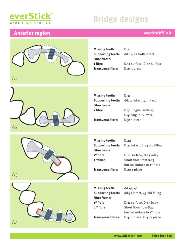 Everstick Anteriorbridgedesign | PDF