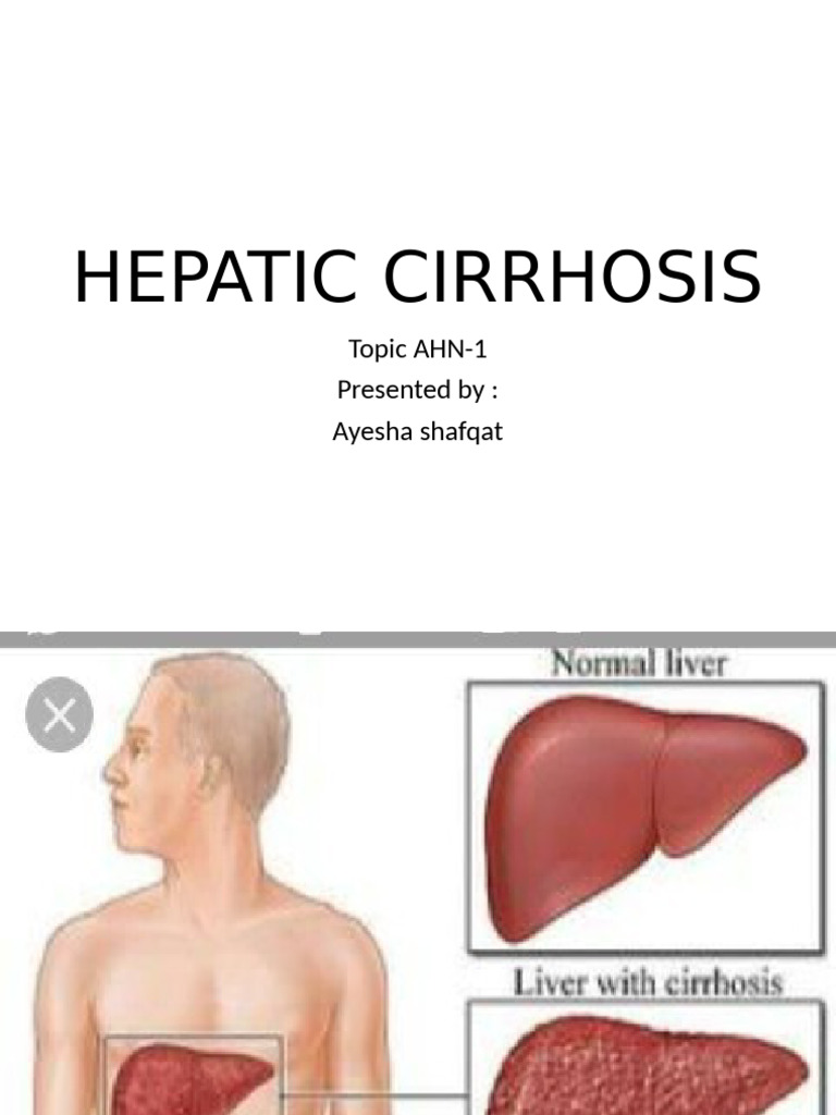 Liver Cirrhosis | PDF