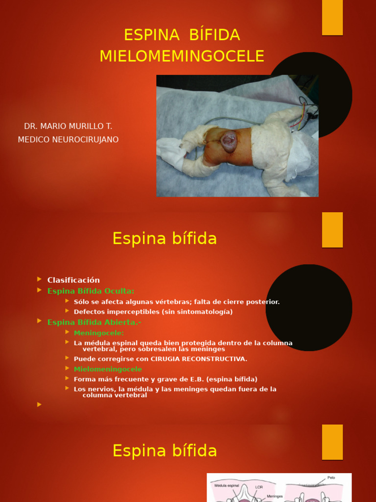 Espina Bífida MMC | PDF