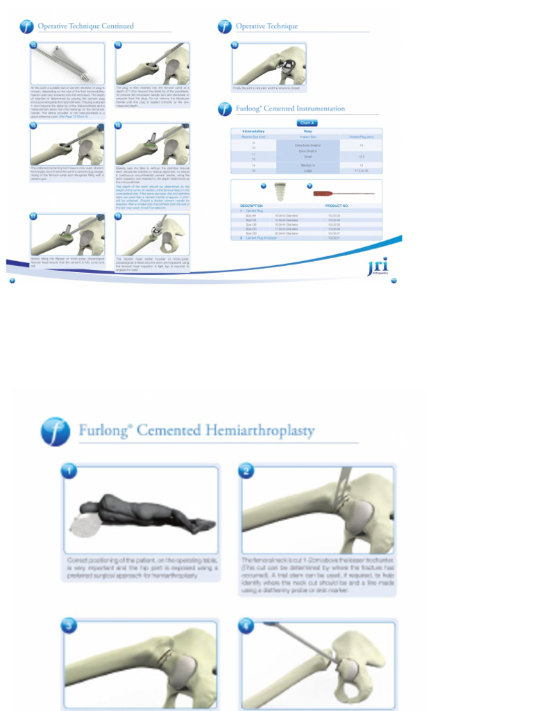 Furlong Cemented Hip Hemiartroplasty MBA | PDF