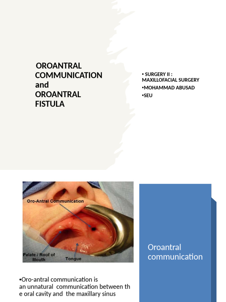 Oroantral Fistula Mohammad Abusad | PDF