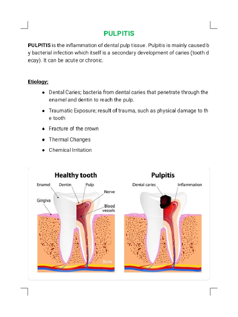 Pulpitis Copy Copy - Phoenix | PDF