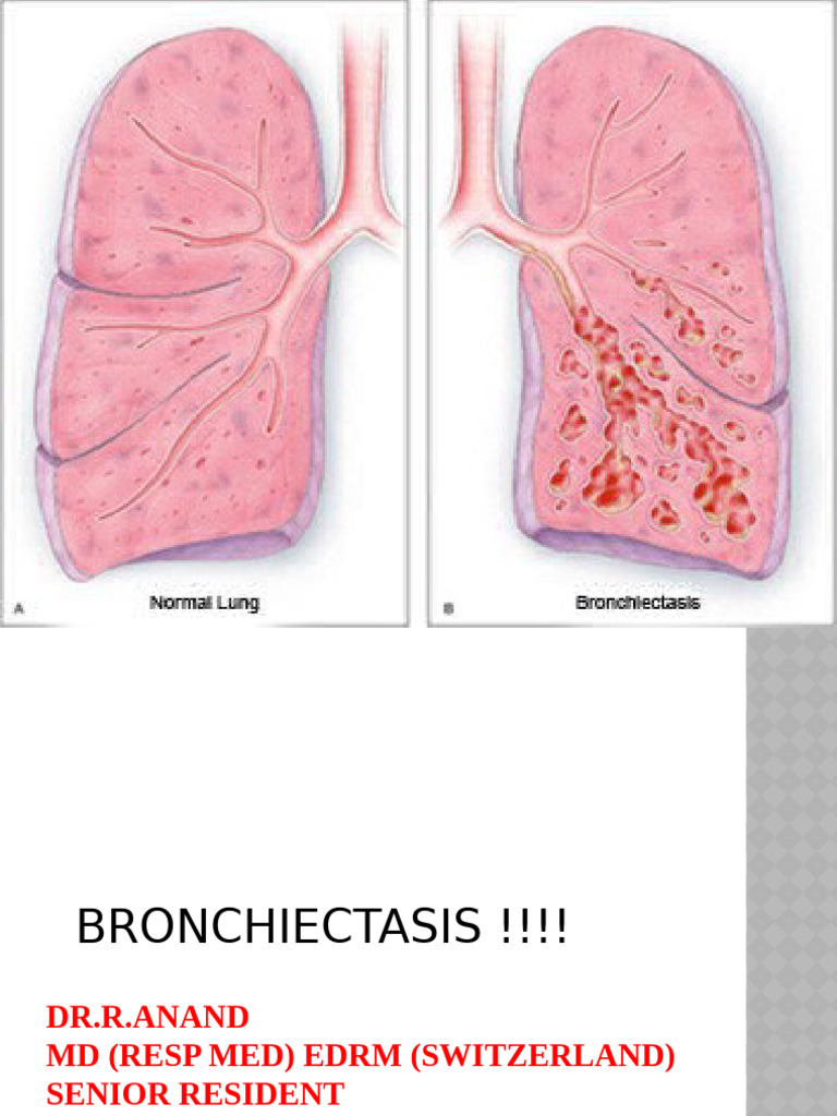 Bronchiectasis and Lung Absecess | PDF