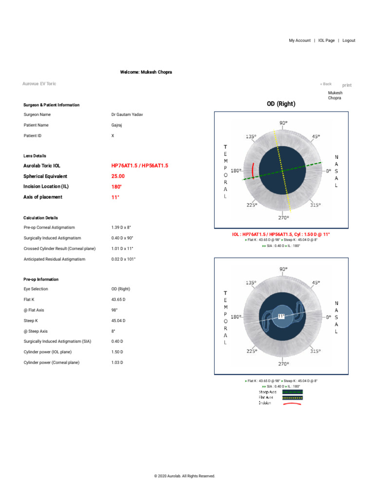 Aurovue EV Toric Calculator | PDF