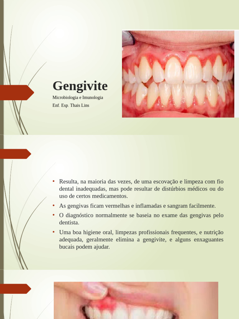 Gengivite | PDF
