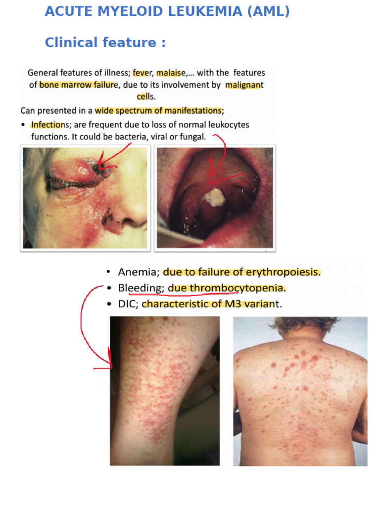 7-Acute Myeloid Leukemia (Aml) | PDF