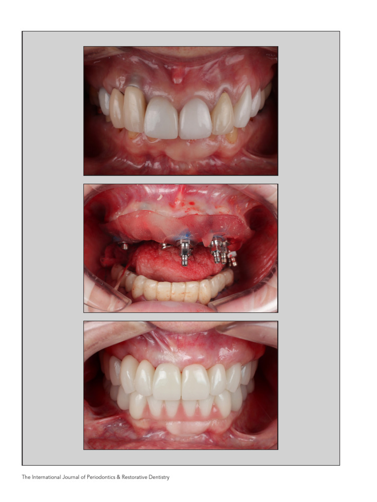 PET Partial Extraction Therapy Part 1: Application in Full Arch | PDF ...