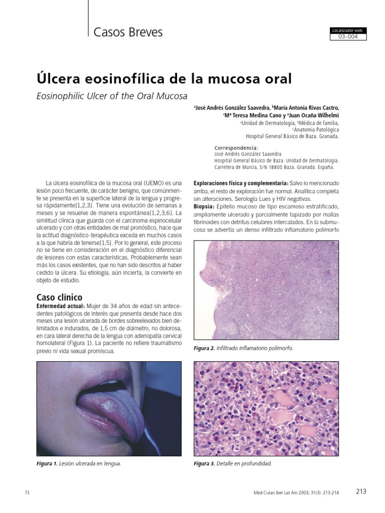 Úlcera Eosinofílica de La Mucosa Oral (Riga-Fede) | PDF