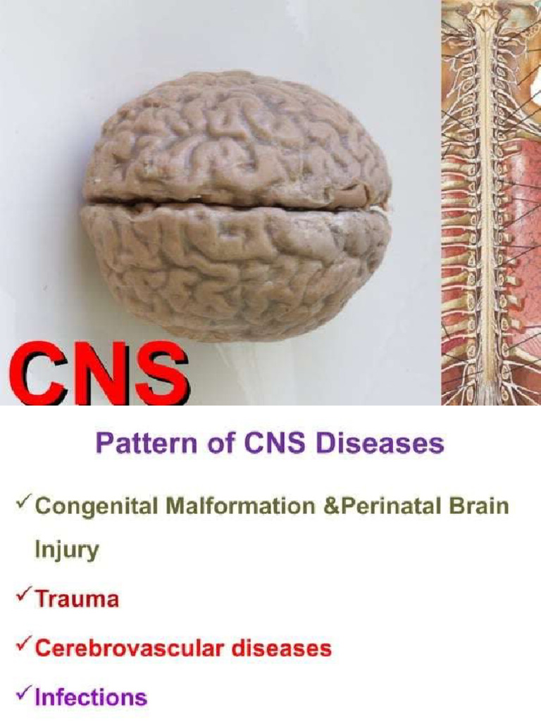 CNS Tumor | PDF