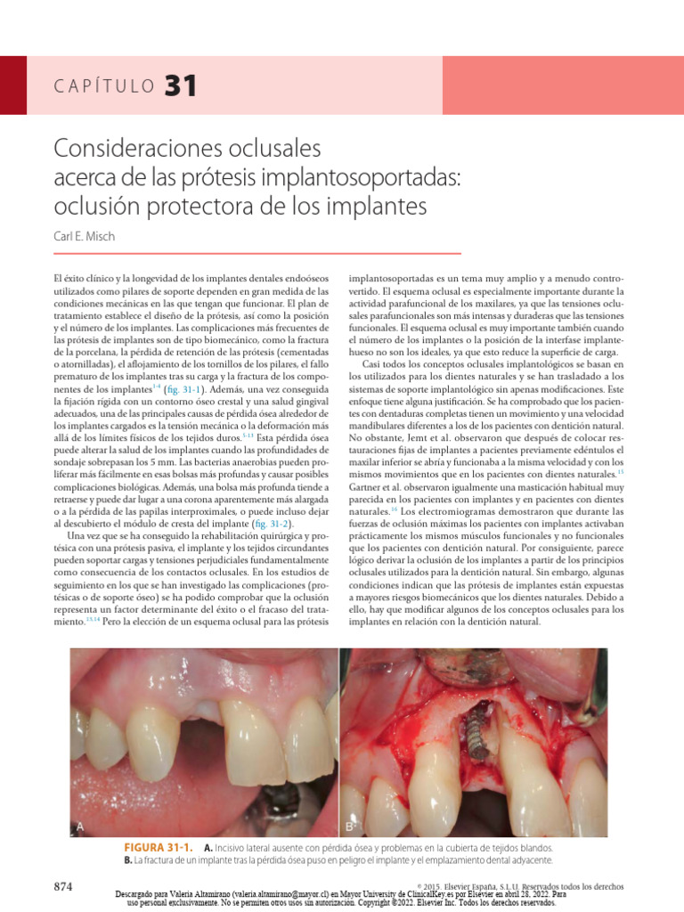 Carl E Misch. Consideraciones oclusales y oclusión protectora | PDF