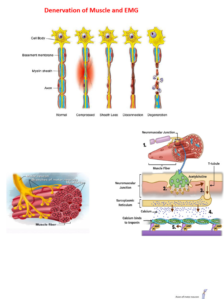 Denervation of Muscle & EMG | PDF