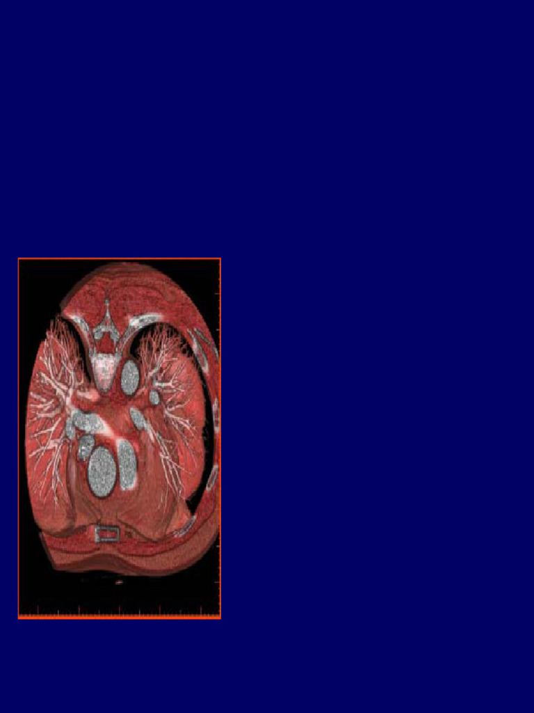 coronaryCTA 200 | PDF | Myocardial Infarction | Ct Scan