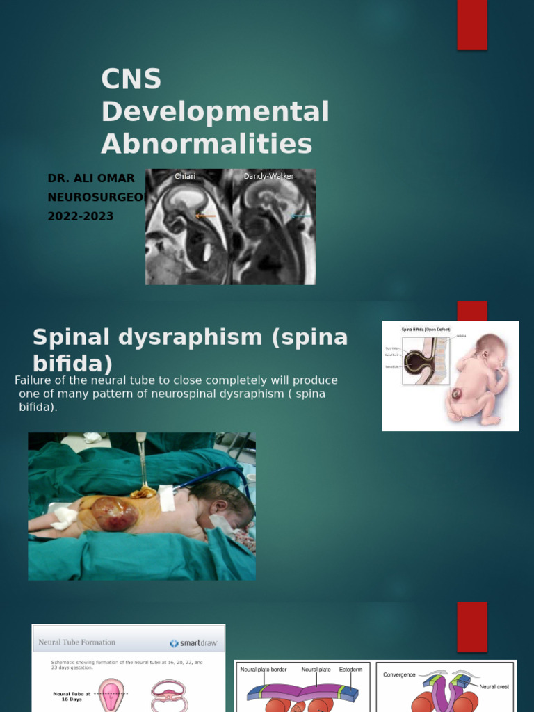 CNS Cong. Abnormality | PDF | Cerebrospinal Fluid | Nervous System