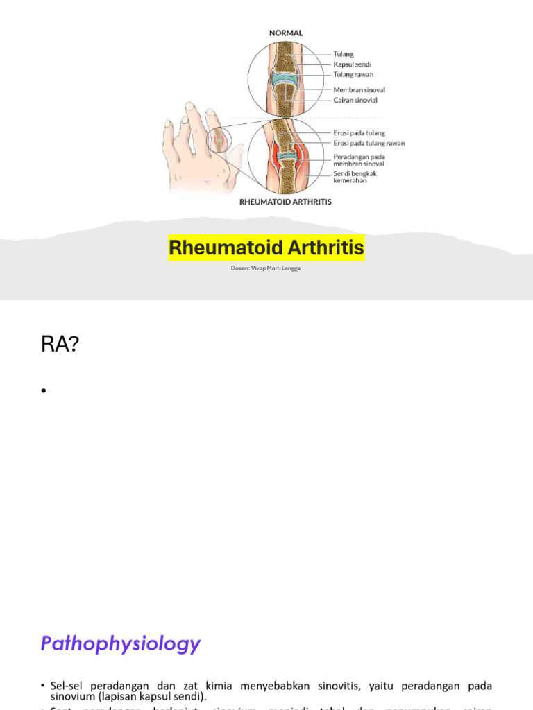 Rheumatoid Arthritis | PDF
