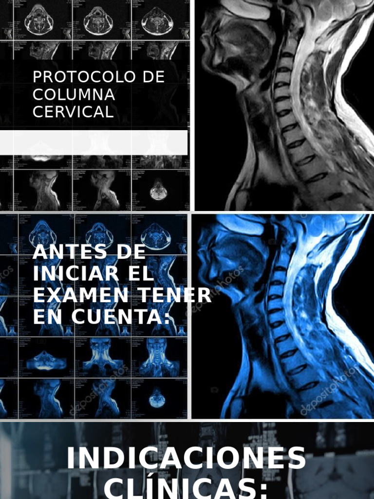 Protocolo de Columna Cervical | PDF