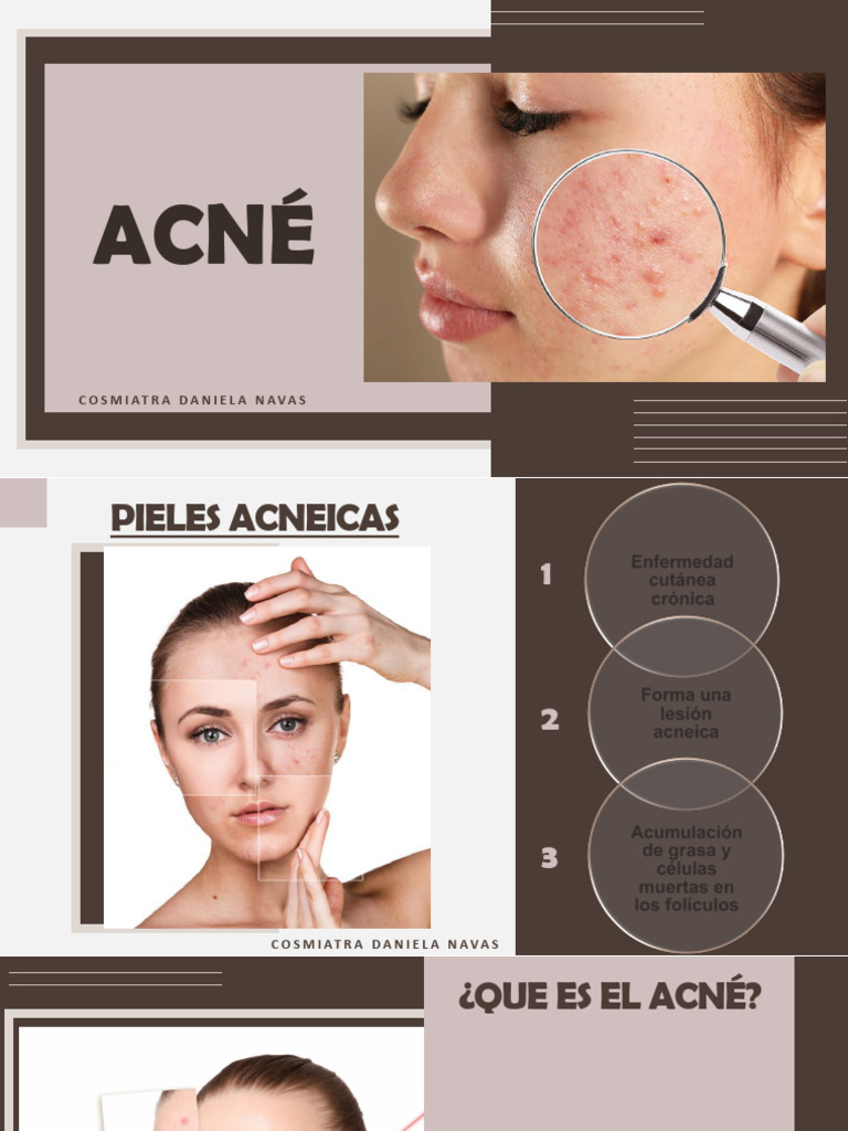 Acne Cosmiatria | PDF | Cicatriz | Piel