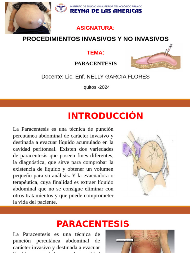 s3. Paracentesis | PDF