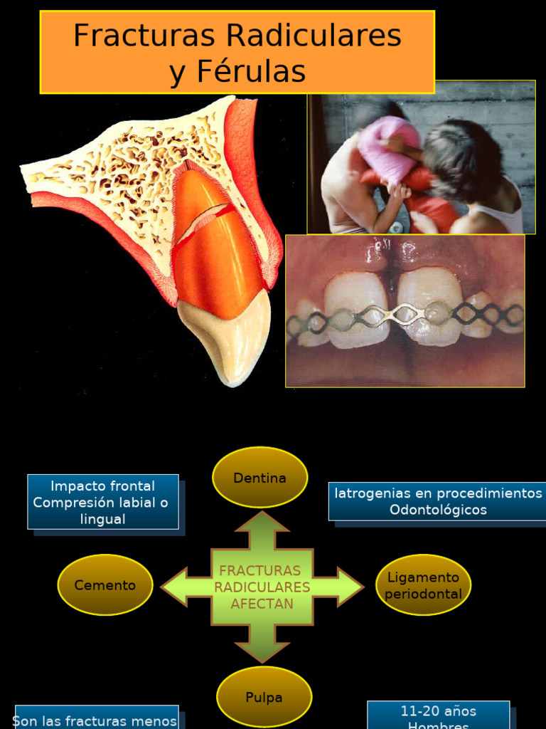Fracturas Radiculares: Diagnóstico y Tratamiento | PDF | Odontología ...