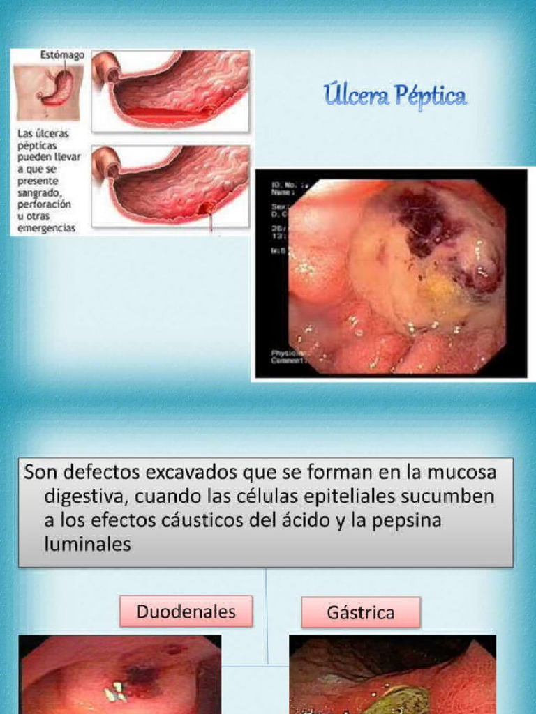 Úlcera Péptica - 20240701 - 073909 | PDF