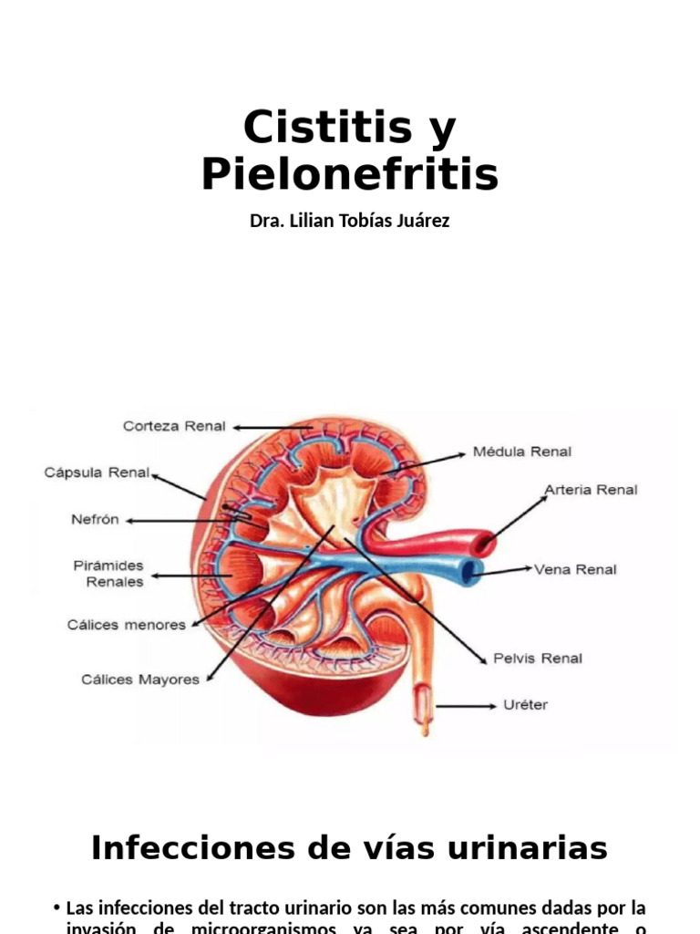 Cistitis y Pielonefritis: Diagnóstico y Tratamiento | PDF | Infección ...