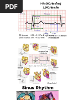 Atrial Fibrillation:Flutter in Pre-Excitation - LITFL - ECG Library ...
