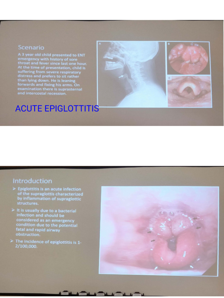 Acute Epiglottitis | PDF